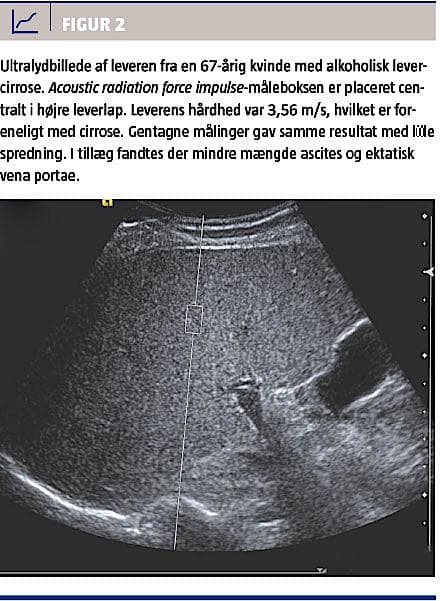 Leverfibrose kan vurderes ved ikkeinvasiv ultralydelastografi ...