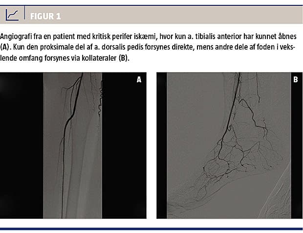 Angiosomrettet revaskularisering af kritisk iskæmiske ben ...