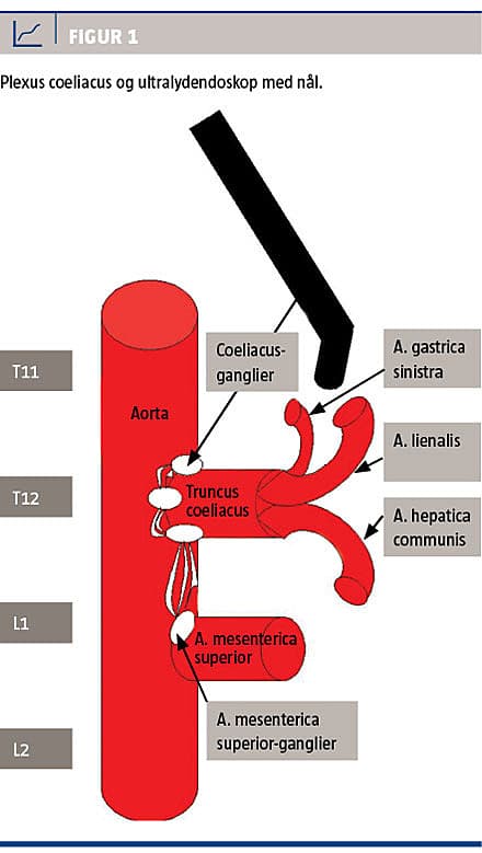 Endoskopisk ultralydvejledt plexus coeliacus-neurolyse til ...