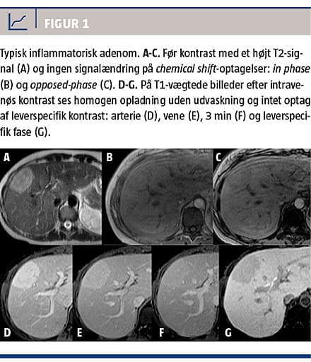 Leveradenomer – ny klassifikation og anbefalinger | Ugeskriftet.dk