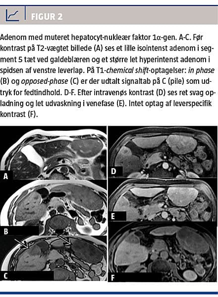 Leveradenomer – ny klassifikation og anbefalinger | Ugeskriftet.dk