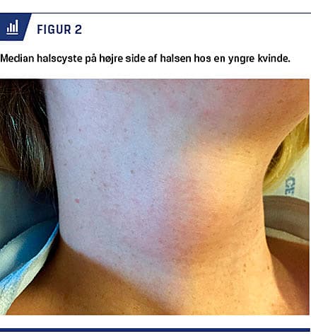 Udredning af knude på halsen hos voksne | Ugeskriftet.dk