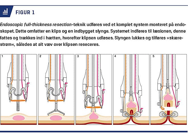 Endoskopisk fuldvægsresektion af adenom i colon | Ugeskriftet.dk