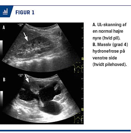 Diagnose og behandling af symptomgivende hydronefrose i graviditeten ...