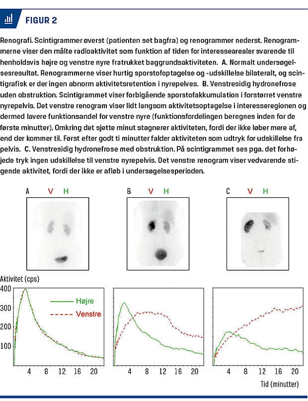 Diagnose og behandling af symptomgivende hydronefrose i graviditeten ...