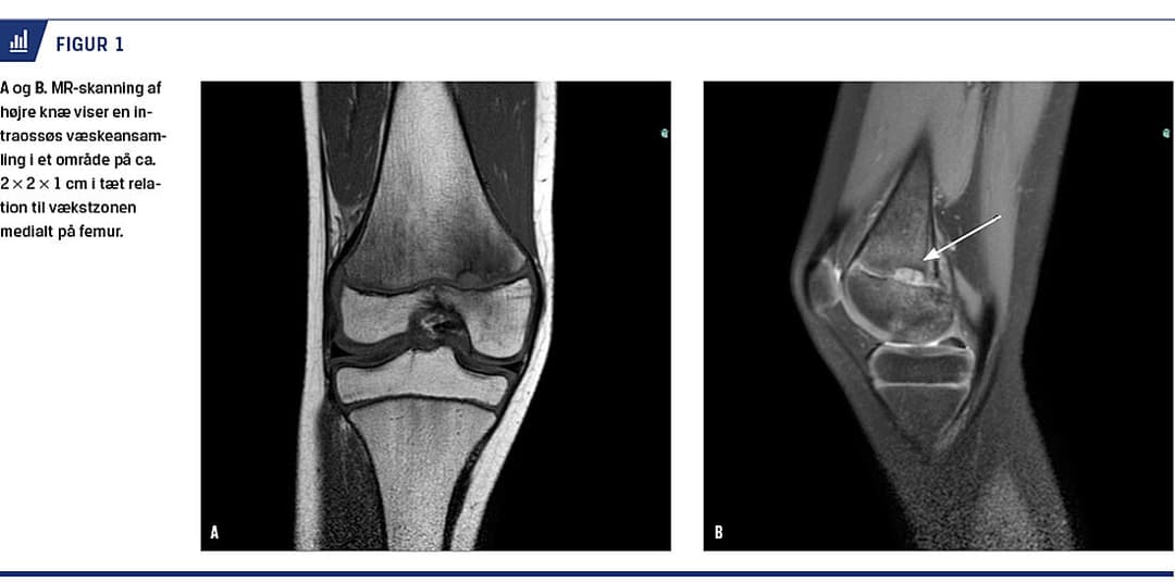 Hæmatogen osteomyelitis som differential-diagnose til knæsmerter hos en ...