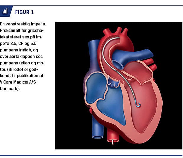 Mekanisk behandling af avanceret hjertesvigt | Ugeskriftet.dk