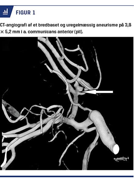 Subaraknoidalblødning som årsag til kramper hos en gravid kvinde ...