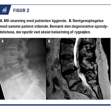 Lumbal spinalstenose | Ugeskriftet.dk