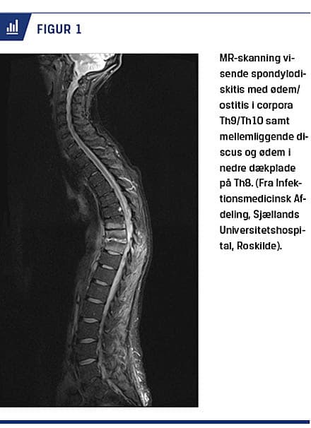 Diagnostik og behandling af spondylodiskitis | Ugeskriftet.dk