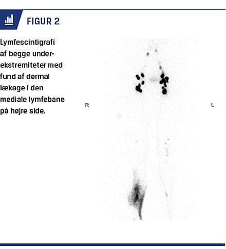 Lymfødem efter hugormebid | Ugeskriftet.dk