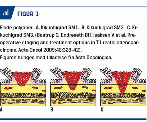 Håndtering af uventet cancer i lokalresecerede kolorektale polypper ...