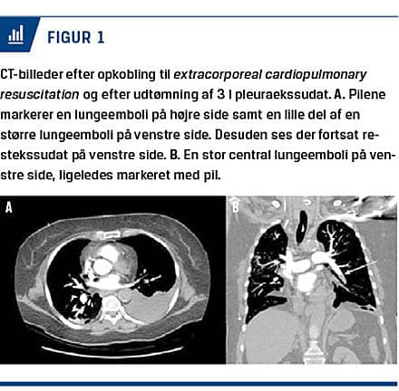 Extracorporeal cardiopulmonary resuscitation til behandling af ...