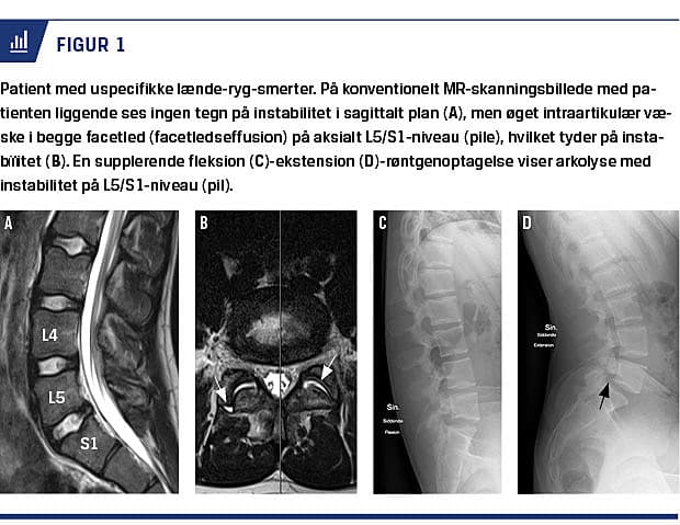 Billeddiagnostik ved lænde-ryg-smerter | Ugeskriftet.dk