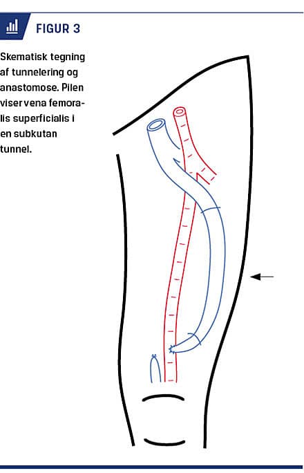 Arteriovenøs fistel med transponeret vena femoralis er en ...