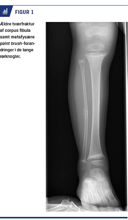Rakitis og anæmi betinget af cøliaki hos en tre år gammel pige ...