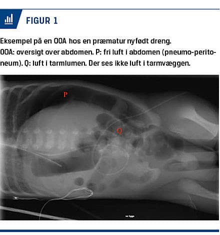 Intrauterin nekrotiserende enterokolitis hos præmature nyfødte ...