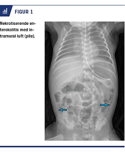 Nekrotiserende enterokolitis | Ugeskriftet.dk