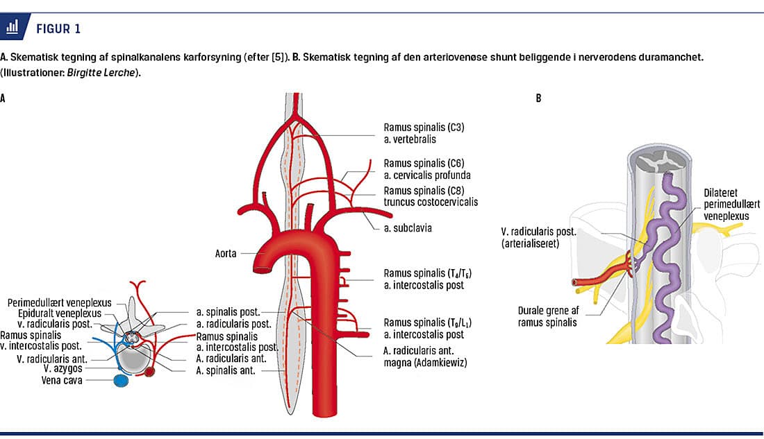 Den spinale durale arteriovenøse fistel er en overset lidelse ...