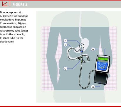 Duodopa pump treatment in patients with advanced Parkinson‘s disease ...