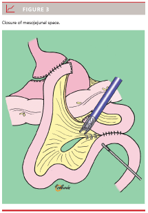 Effect of closure of the mesenteric defect during laparoscopic gastric ...