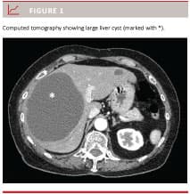 Good results after laparoscopic marsupialisation of simple liver cysts ...