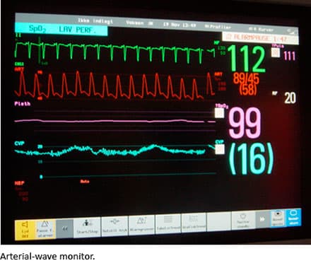Arterial waveform-analysis is of limited value in daily clinical ...