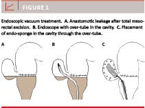 Promising results after endoscopic vacuum treatment of anastomotic leakage following resection ...