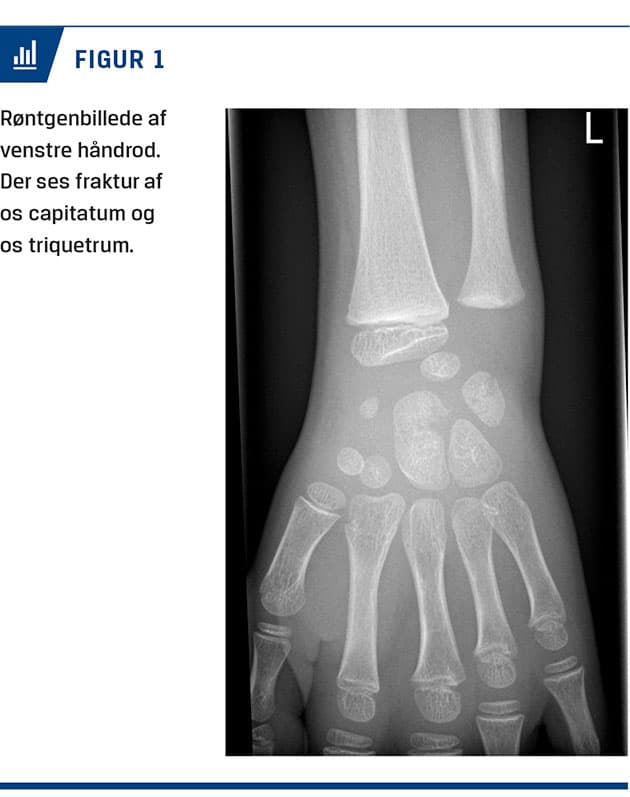 Barn med fraktur af os capitatum og os triquetrum | Ugeskriftet.dk