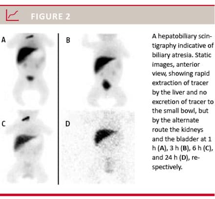 cholangiopancreatHepatobiliary scintigraphy for early diagnosis of ...