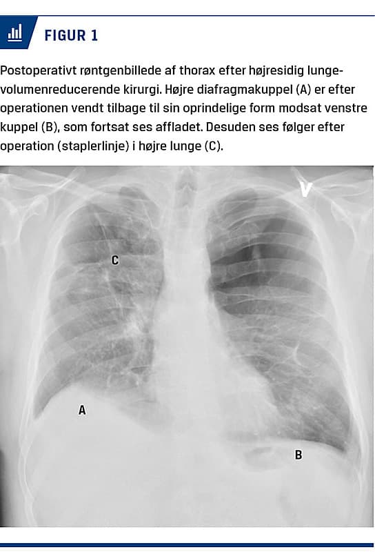 Kirurgisk lungevolumenreduktion til behandling af svært emfysem ...