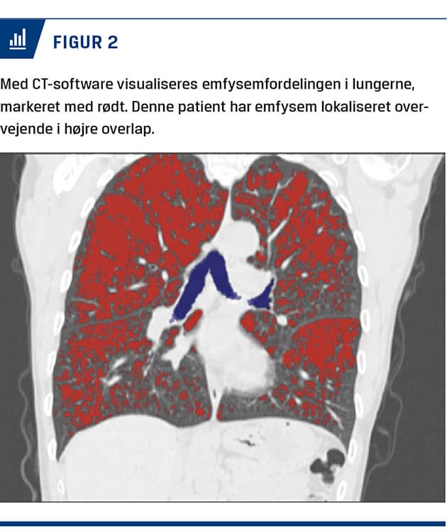 Kirurgisk lungevolumenreduktion til behandling af svært emfysem ...