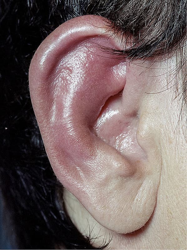 Relapsing polychondritis | Ugeskriftet.dk