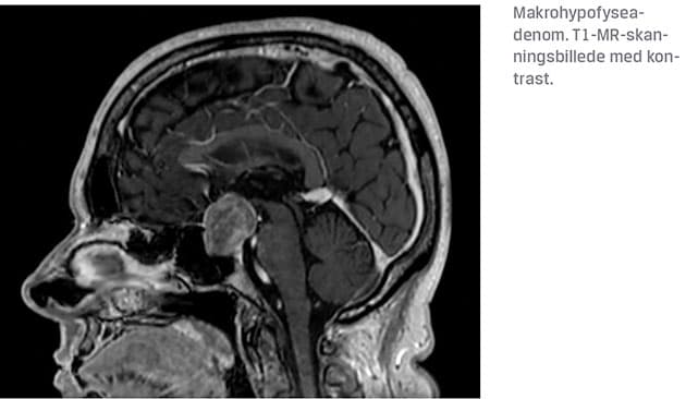 Hypofyseadenom | Ugeskriftet.dk