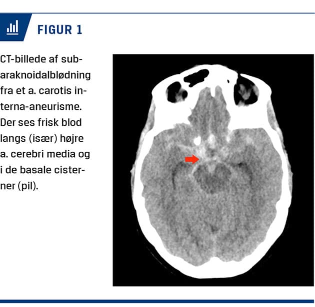 Aneurismal subaraknoidalblødning | Ugeskriftet.dk