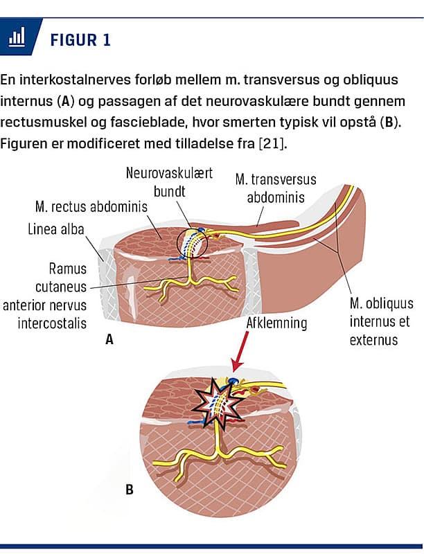 Anterior cutaneous nerve entrapment syndrome | Ugeskriftet.dk