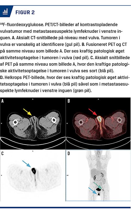 Udredning, behandling og opfølgning af vulvacancer | Ugeskriftet.dk