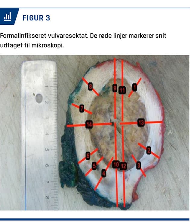 Udredning, behandling og opfølgning af vulvacancer | Ugeskriftet.dk
