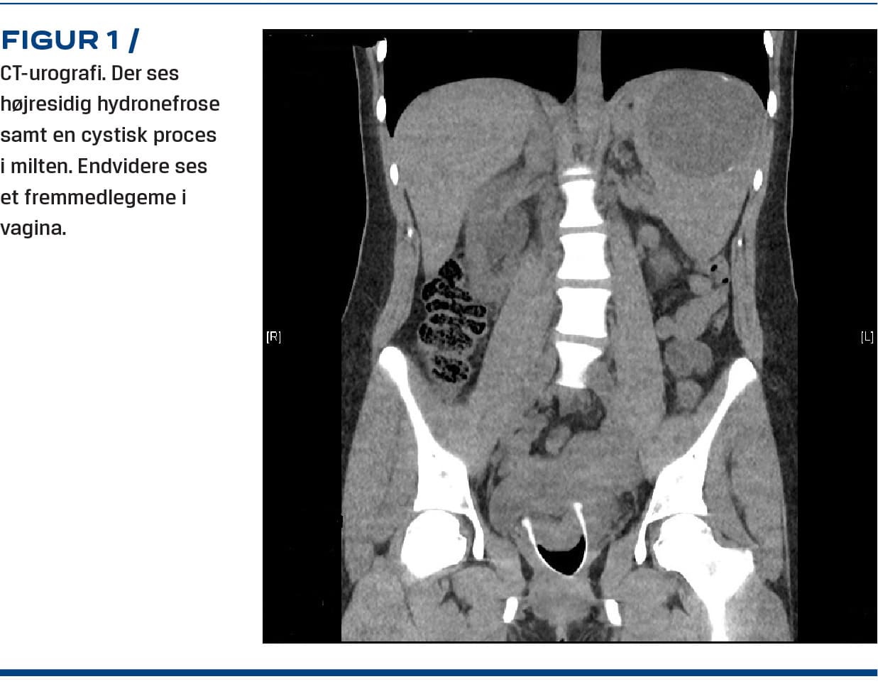 Hydronefrose ved anvendelse af menstruationskop | Ugeskriftet.dk