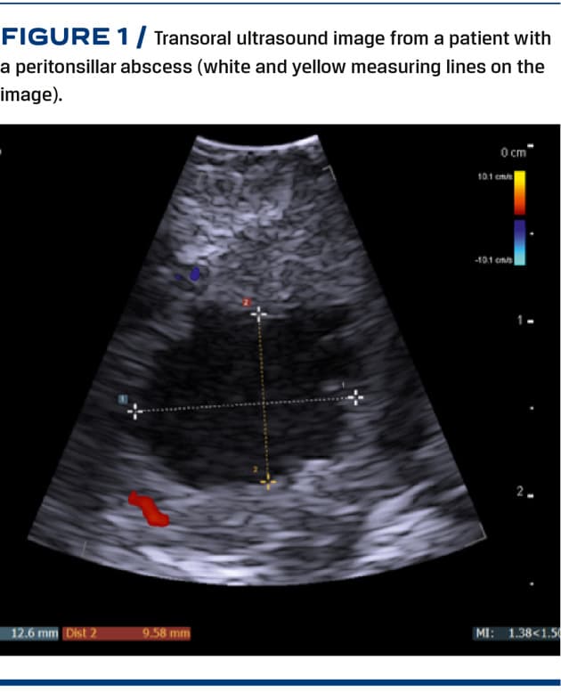Protocol for a randomised clinical trial of transoral ultrasound versus ...