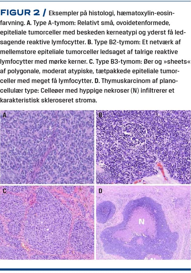 Behandling af tymom og thymuskarcinom | Ugeskriftet.dk