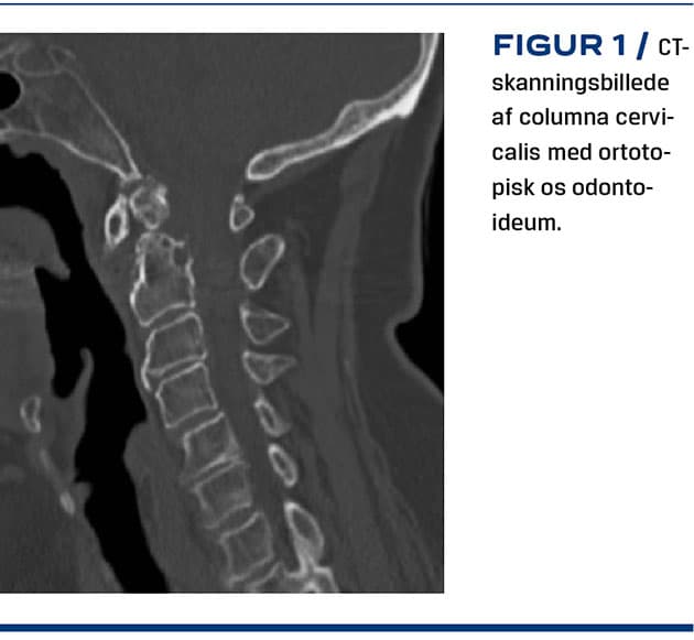 Os odontoideum kan ubehandlet medføre tetraplegi | Ugeskriftet.dk