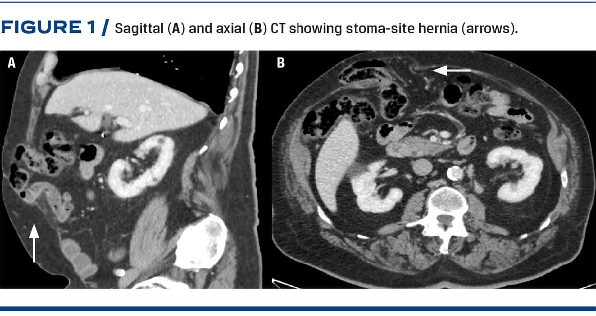 Stoma-site hernia after stoma reversal following rectal cancer ...