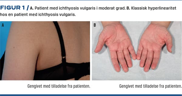 Ichthyosis vulgaris | Ugeskriftet.dk