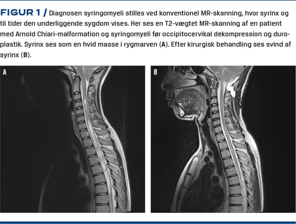 Cerebrospinalvæskens flowdynamik og fasekontrast-MR-skanning ved ...