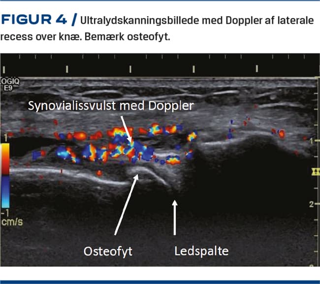 Definition, patologi og patogenese af artrose | Ugeskriftet.dk