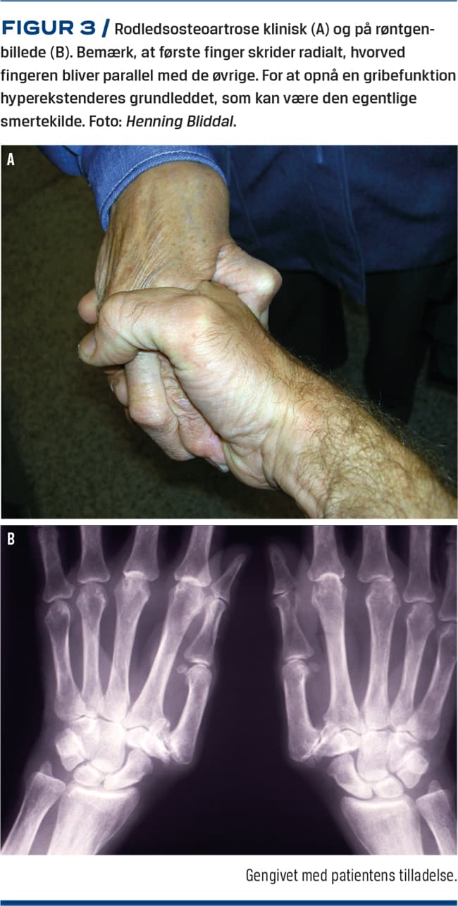 Definition, patologi og patogenese af artrose | Ugeskriftet.dk