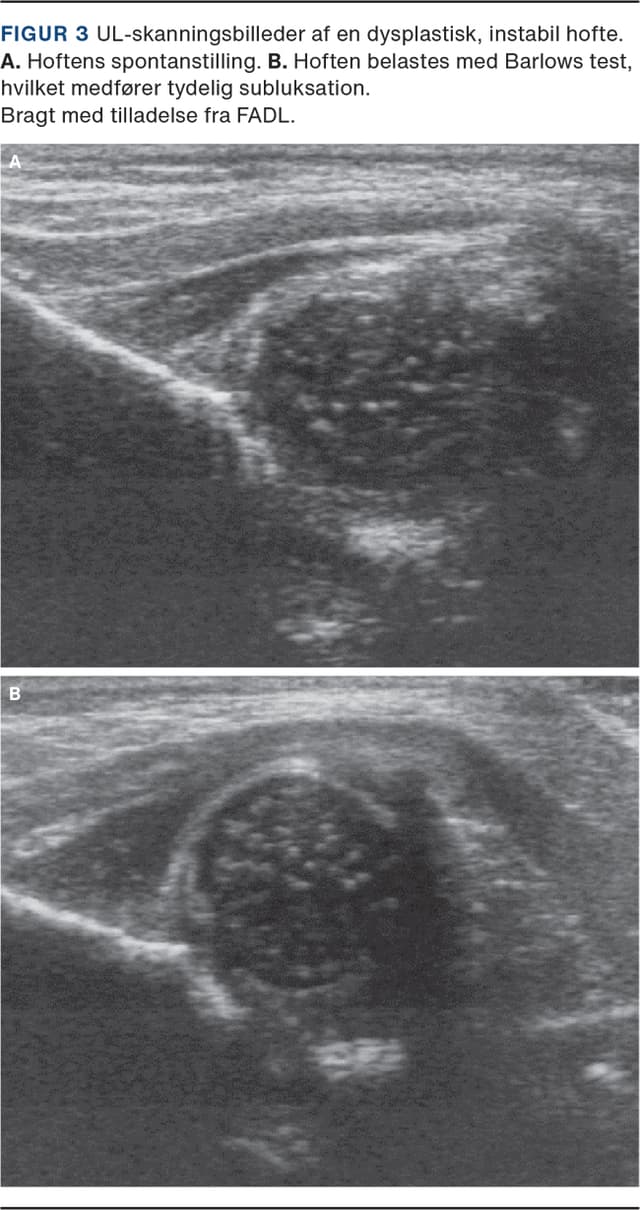 Screening for hoftedysplasi | Ugeskriftet.dk