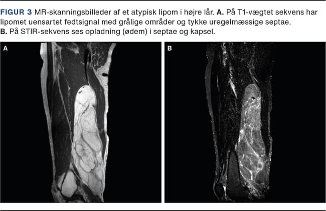 Udredning og behandling af lipomer | Ugeskriftet.dk