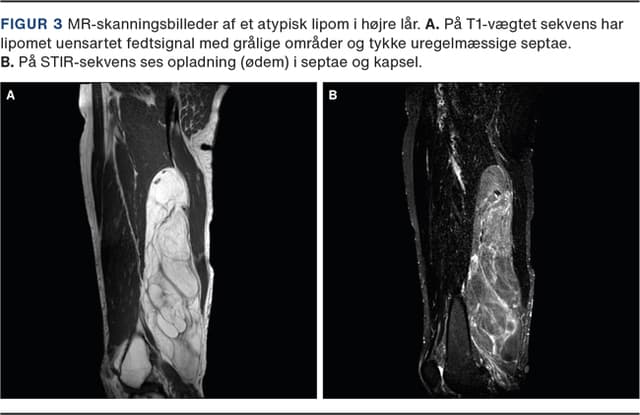 Udredning og behandling af lipomer | Ugeskriftet.dk